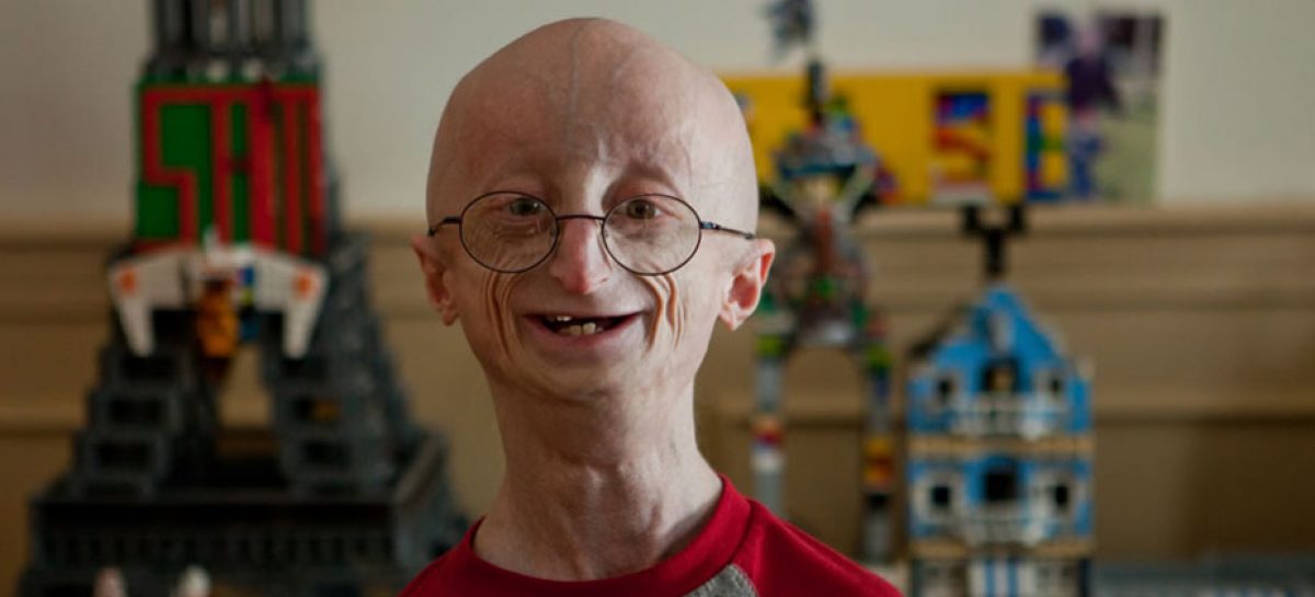 Knowing Progeria, an aging disease caused by gene mutation | Healthy ...