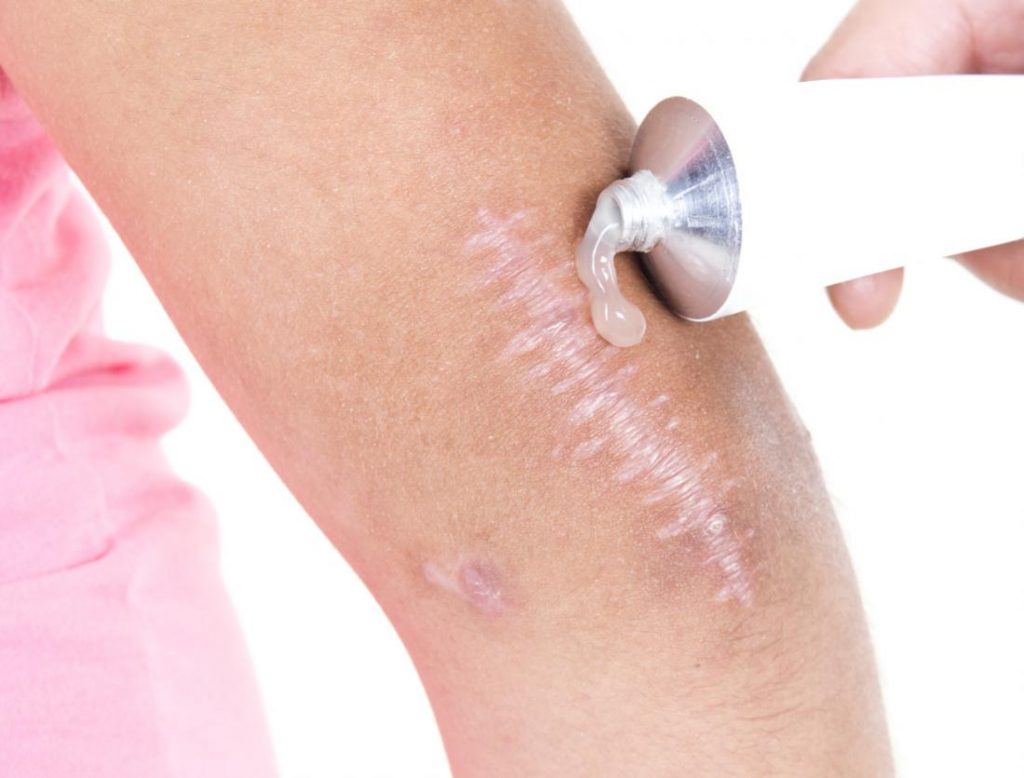 What You Need To Know About Treating and Minimizing Old Scars - Healthy ...