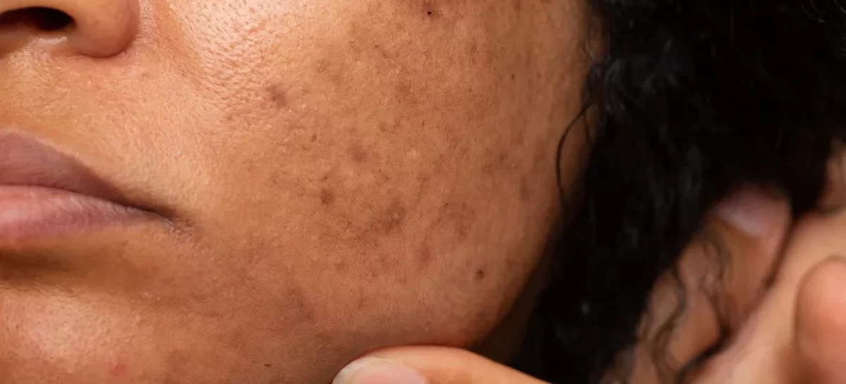 Acne and Dark Spots | Healthy Panacea
